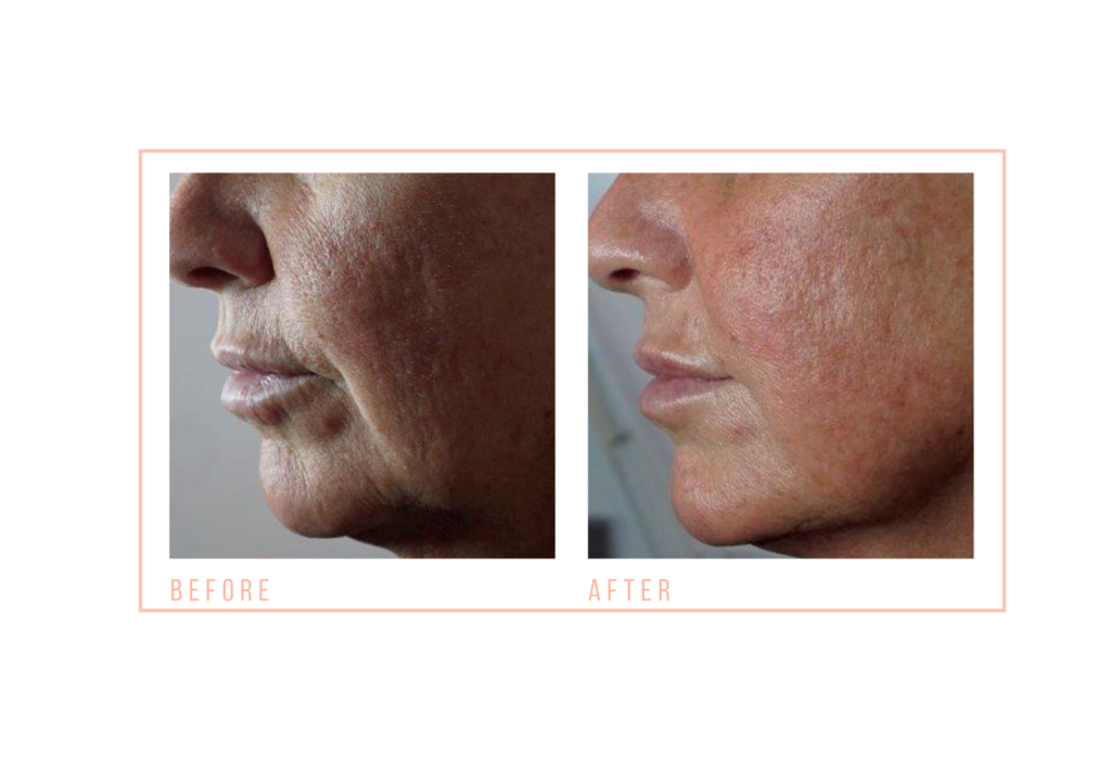 CACI Treatments in Chorley at Mojo's Beauty Salon