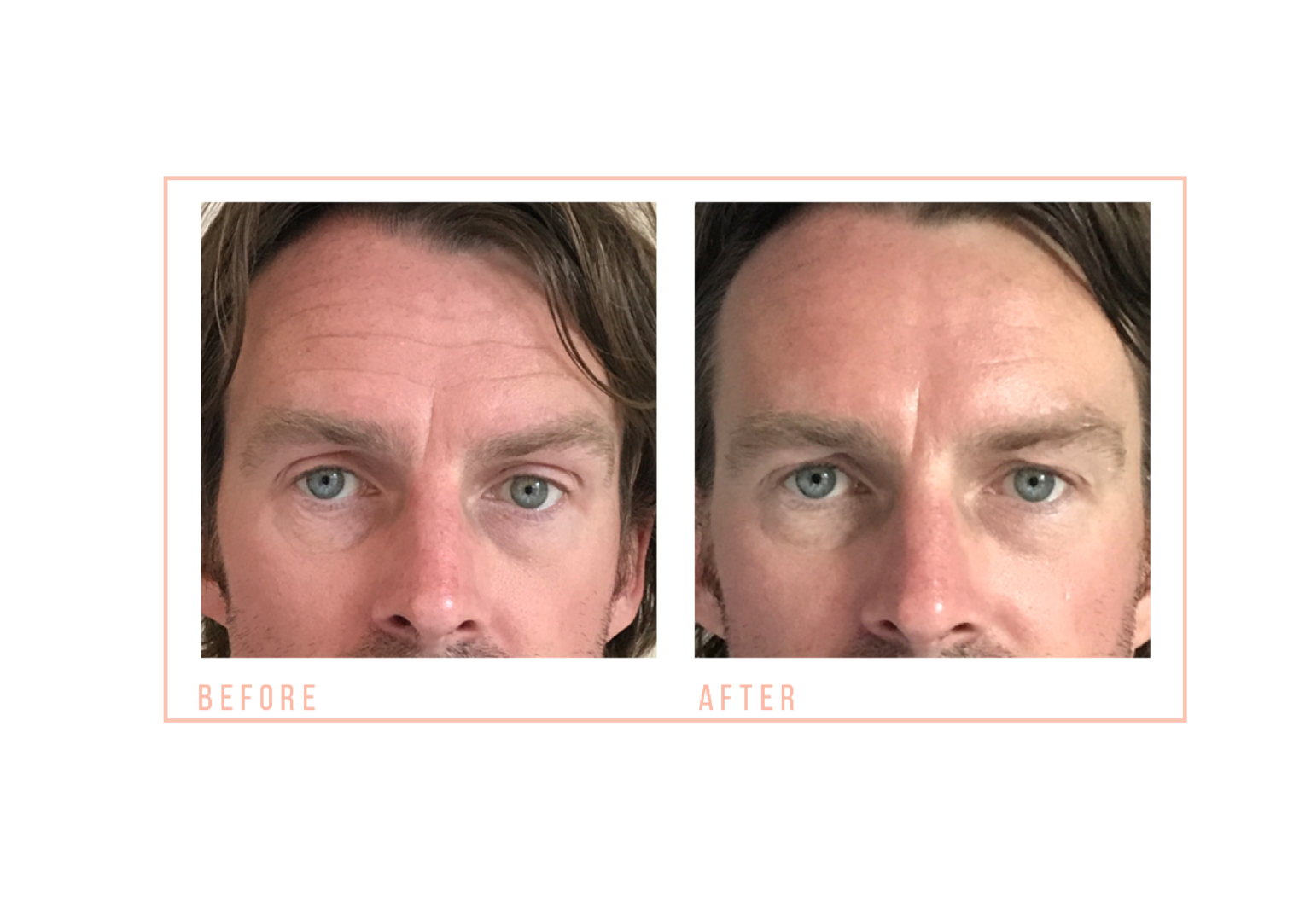 CACI Treatments in Chorley at Mojo's Beauty Salon