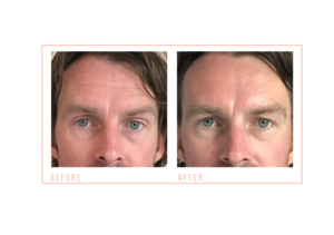 CACI Treatments in Chorley at Mojo's Beauty Salon