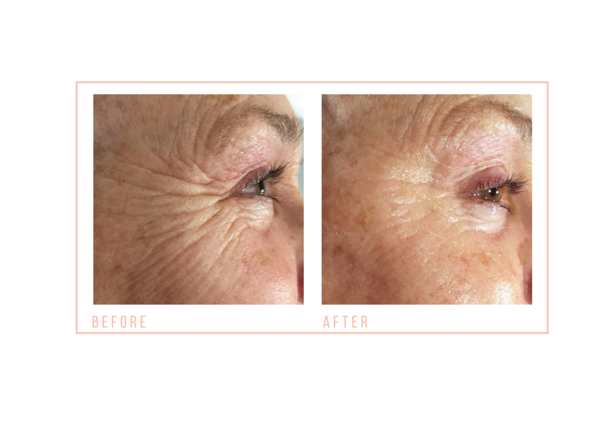 CACI Treatments in Chorley at Mojo's Beauty Salon